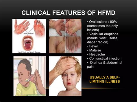 Hand Foot Mouth Disease Hfmd Pdf