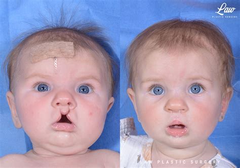 Bilateral Cleft Lip Classification Of Cleft Lip And Palate Balaji