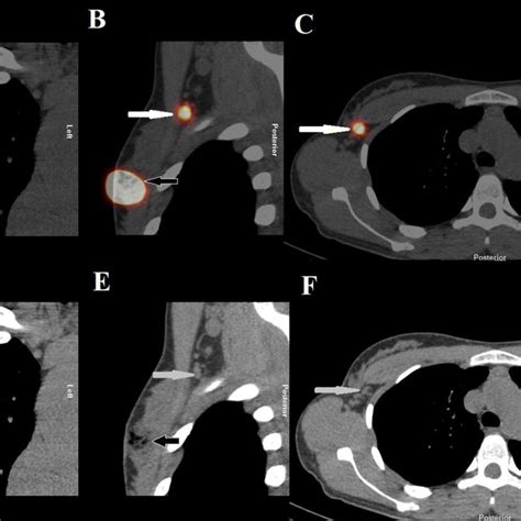 Spectct Lymphoscintigraphy Of Patient Undergoing Pre Operative Download Scientific Diagram