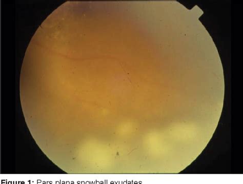 Figure 1 From Intermediate Uveitis Semantic Scholar