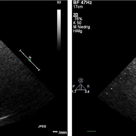 Exemplary Image From Apical Transthoracic Echocardiography Bubble Test