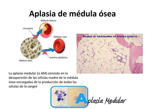 Insuficiencia De La Medula Osea Hematologia Pptx