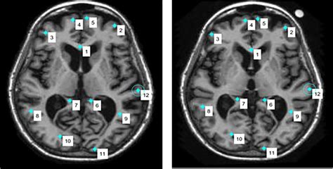 example of matching between 11 pixels key points of a target mri