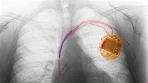 Over 8000 Bugs Found In Pacemaker Codes Leaving Them Vulnerable To
