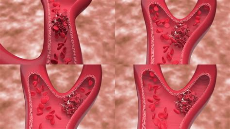 医疗血管血栓形成 视频素材下载