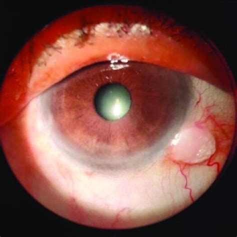 Pre Operative Lesion Download Scientific Diagram