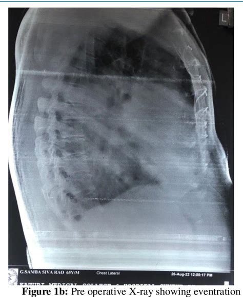 Figure 1 From A Rare Case Of Eventration Of Diaphragm Semantic Scholar