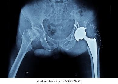 Xray Post Operation Total Hip Arthroplasty Stock Photo 508083490 Shutterstock