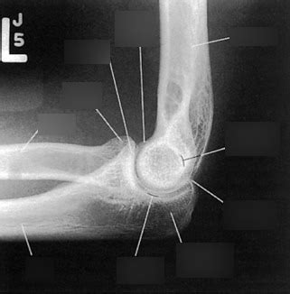 Lateral Elbow Xray Diagram Quizlet