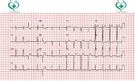 Left Ventricular Hypertrophy Lvh Symptoms Diagnoses And Treatment