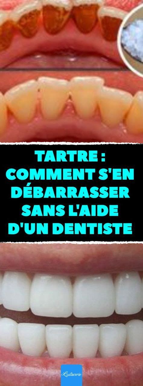 Tartre comment s en débarrasser sans l aide d un dentiste Voici 4 techniques pour s e