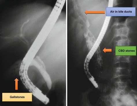 Hepatobiliary Complications Of Sickle Cell Anemia Oncohema Key