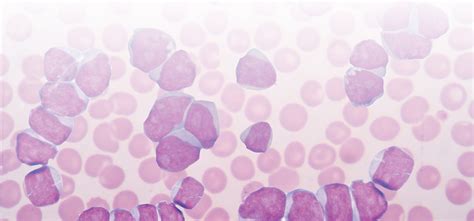 Huidige En Toekomstige Behandelingen Voor Acute MyeloÏde Leukemie Ntvh