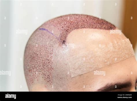 End To Baldness Concept Male Scalp After Hair Implant Surgery Stock
