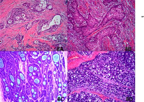 Figure 8 From Distribution And Frequency Of Parotid Gland Tumors In The