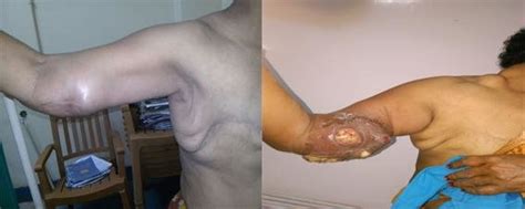 Metastatic Epitrochlear Lymph Node Progressive Disease Epitrochlear