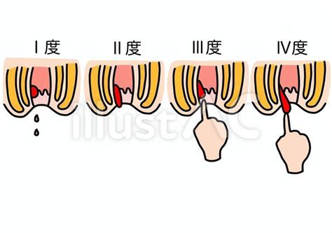 Free Vectors Classification By The Degree Of Hemorrhoid Progression Color