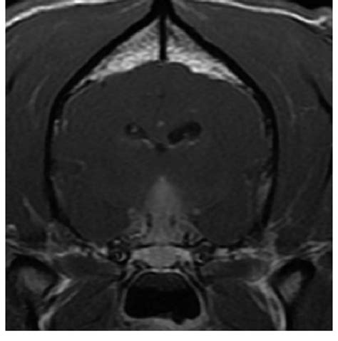 Transverse T1 Weighted Image After Administration Of Contrast Showing