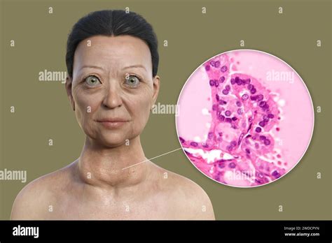 Exophthalmos Bulging Eyes Due To Thyroid Disease Stock