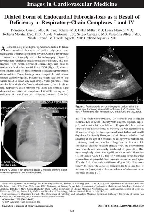 Dilated Form Of Endocardial Fibroelastosis As A Result Of Deficiency In