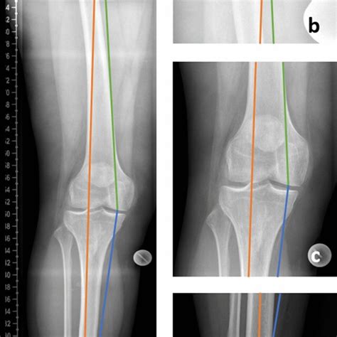 biometric linear distance measurements taken on the long leg