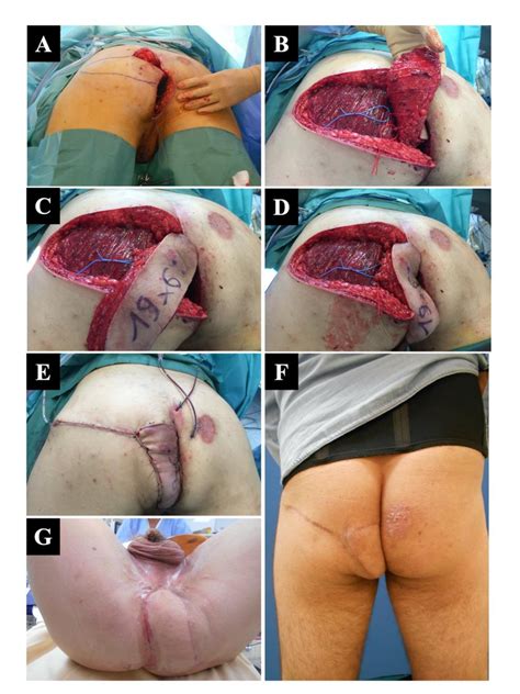 Deep Perineal Defect Following Abdominoperineal Amputation Aap In A