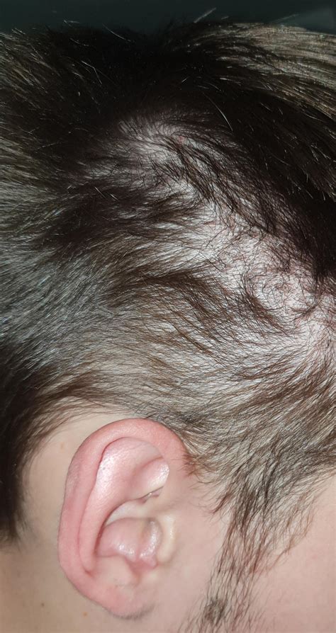 Diffuse Alopecia Areata R Alopecia Areata