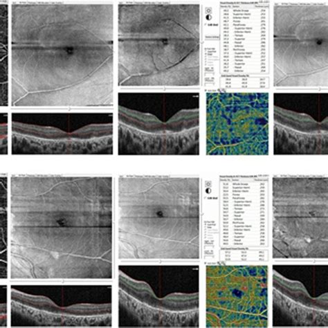 Octa Showed That The Deep Retinal Capillary Density Decreased And The Download Scientific