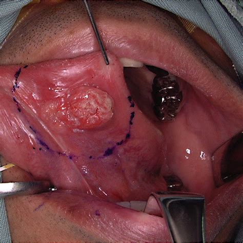 Ct Showing A Primary Tumour In The Right Glossotonsillar Sulcus Black Download Scientific