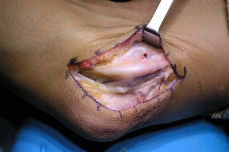 Nerf Ulnaire Au Coude Nerf Cubital Trajet Compression Libération Pr Eric Roulot