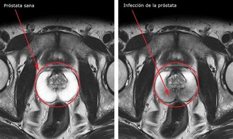 Prostatitis Causas Diagnóstico Tratamiento Y Prevención