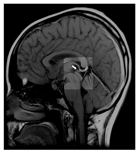 Fluoride And Pineal Gland