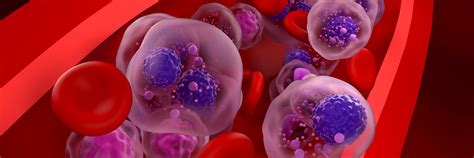 Understanding Key Prognostic And Treatment Advances In Multiple Myeloma