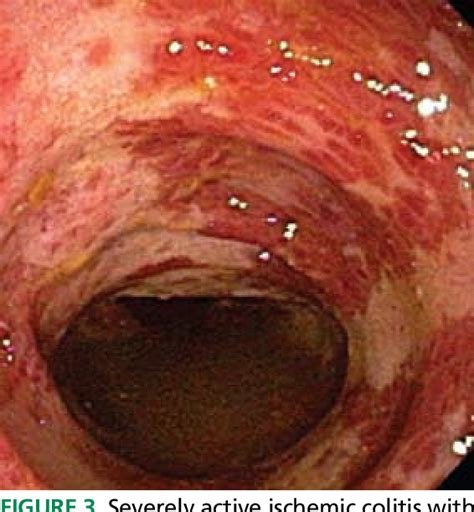 Table 1 From Clinical Approach To Colonic Ischemia Semantic Scholar