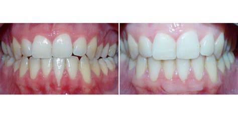 10 Causas que provocan la recesión gingival Clínica Dental Gramadent