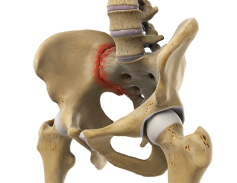Sacroiliac Dysfunction Sacroiliac Joint Palomar Health San Diego
