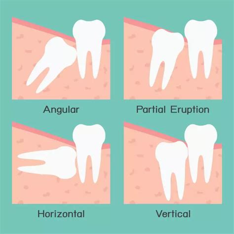 Get More Information About Wisdom Teeth Extractions