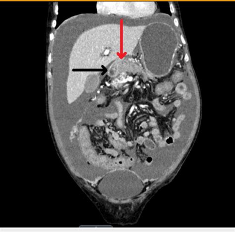 Diffuse Mass Like Enlargement Of The Pancreatic Body And Tail Red