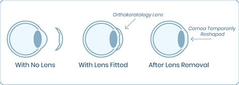 Ortho K In Seattle Orthokeratology Center Of Washington