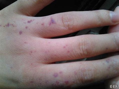 血管角皮瘤 爱爱医医学网