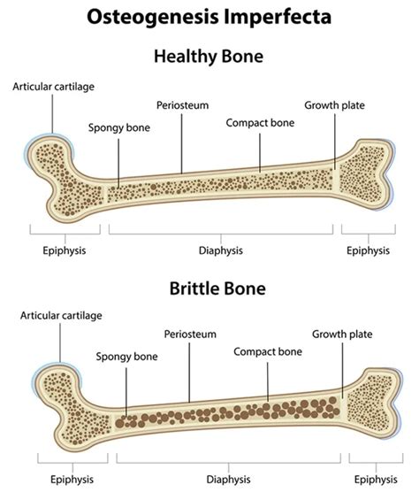 Osteogenesis Imperfecta Type 1