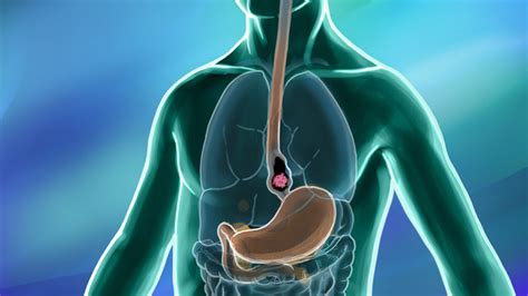 Esophageal Cancer Causes Symptoms And Treatment Options