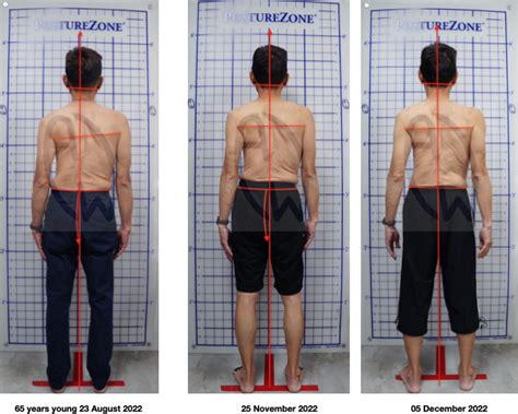 Understanding Lower Back Pain And Scoliosis All Well Scoliosis Centre