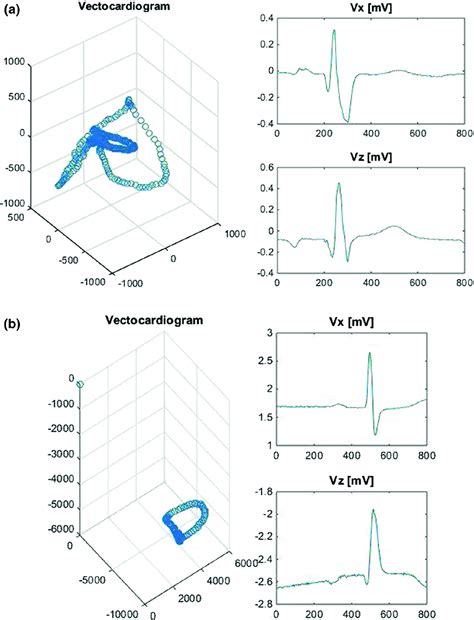 Vectorcardiogram At Collection Of Vectorcardiogram Free For Personal Use