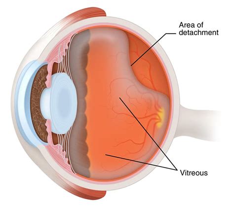 Posterior Vitreous Detachment Floaters