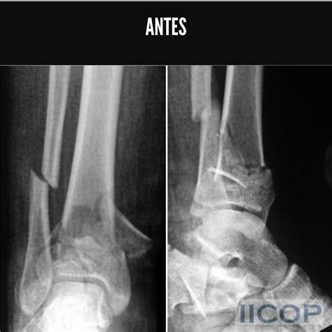 Fractura De Pilón Tibial Los Mejores Especialistas En Cirugía De Pie