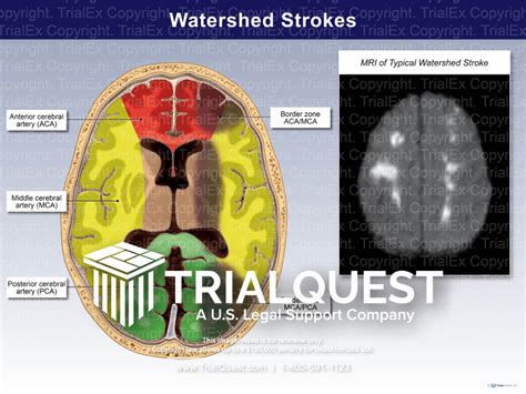 Watershed Strokes Trialexhibits Inc
