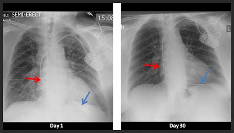 Pacemaker Lead Malposition