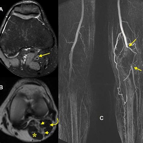 Popliteal Artery Entrapment Syndromes In Two Patients Download
