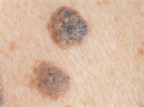25 Familial Atypical Mole Malignant Melanoma Background Bbc Fans